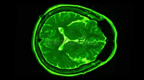 Human MRI Brain Scan On Black Background Computed Tomography Of The Human Brai Stock Footage
