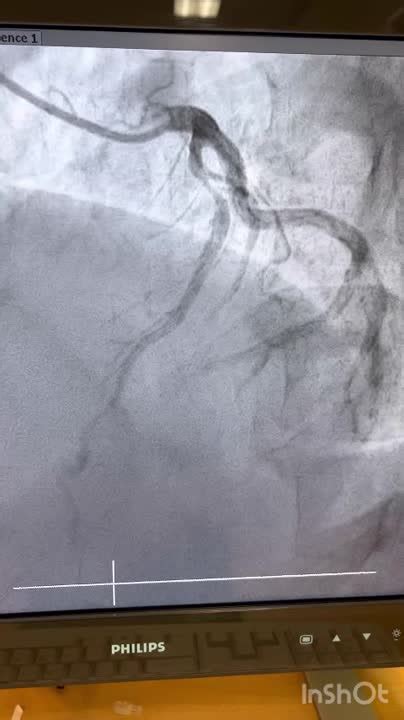 Lad Diagonal Bifurcation Minicrush Technique In Middle Of Case We Saw