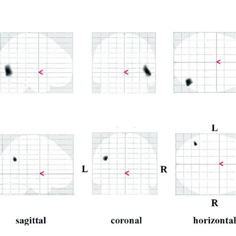 statistical parametric maps spms reflecting group differences