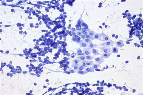 Smallcelllungcarcinomavsbenignmesothelialcells4703634468