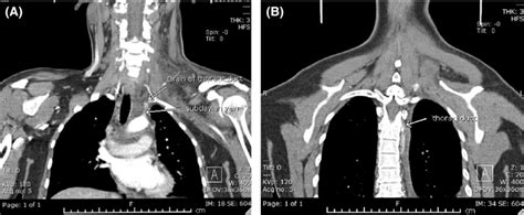 A And B Ct Scan Showing Left Neck Subcutaneous Edema The Track Of