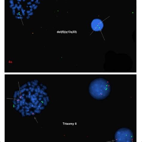 G Banded Metaphase From Bone Marrow Revealed A Karyotype Of