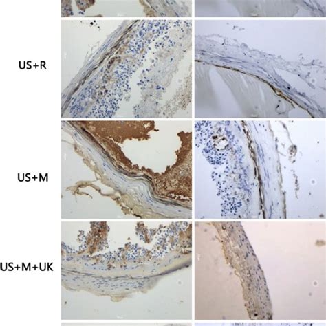 Expression Of Tissue Factor Tf And Von Willebrand Factor Vwf Us