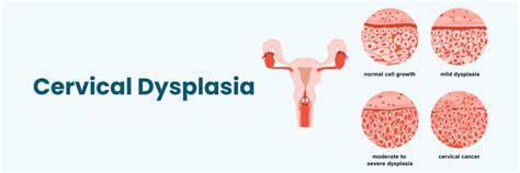 Cervical Dysplasia Symptoms Causes And Treatment Options