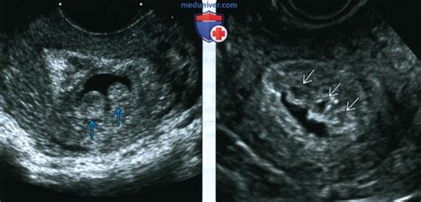 Chorionic Bump что это