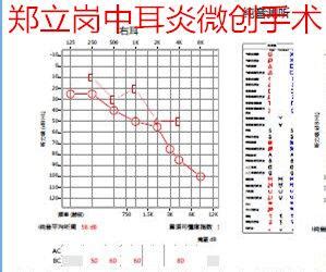 鼓膜大穿孔建議及時做耳內鏡微創手術 每日頭條