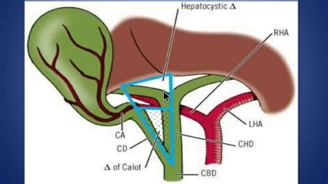 Calots Triangle