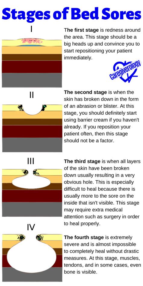 Bed Sores Explained In Detail Caregiverology