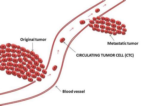 Liquid Biopsy May Help Predict Breast Cancer Relapse Nci