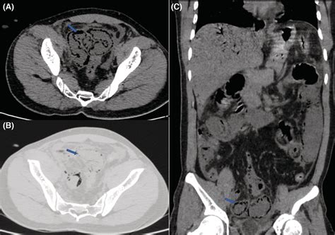 A Axial Noncontrast Soft Tissue Window B Axial Noncontrast