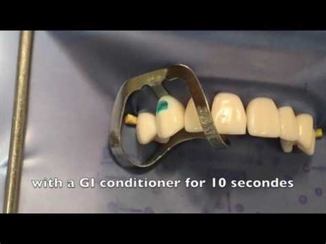 Class V Composite Glass Ionomer Sandwich Technique Preparation
