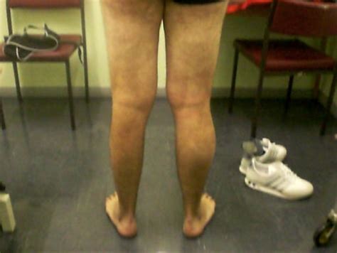 Duchenne Muscular Dystrophy Calf Hypertrophy