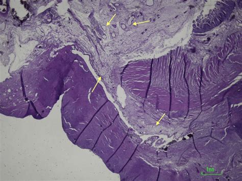 Sclerosing Mesenteritis Presenting As Intestinal Occlusion A Case Report Pmc