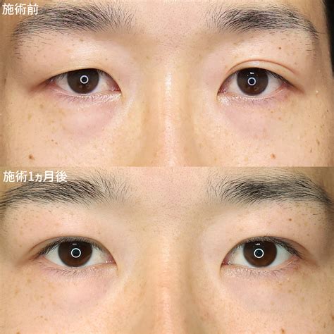 【埋没法】で左右差＆目力up｜症例写真・ビフォーアフター｜美容整形･美容外科のtaクリニックグループ