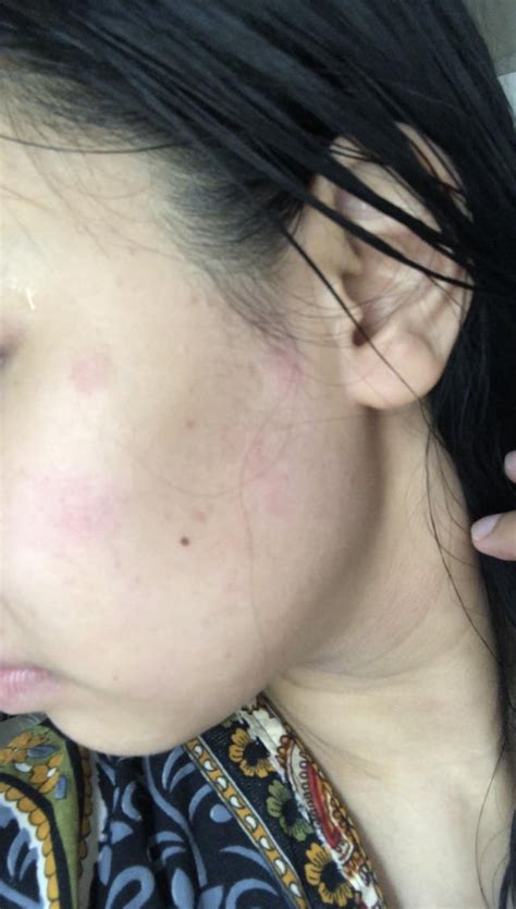 Please Help Is This Ringworm On My Cheek I Do Have History Of Eczema But Only On My Eyelid