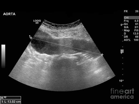 Abdominal Aortic Aneurysm Ultrasound 1 Photograph By Science Photo