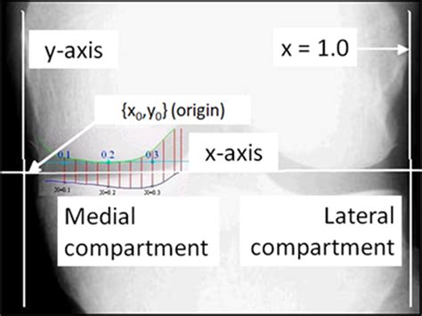 Validation Of Joint Space Narrowing On Plain Radiographs And Its Relevance To Partial Knee