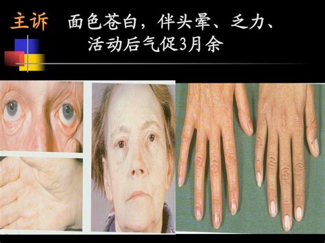 贫血anemia word文档在线阅读与下载 无忧文档