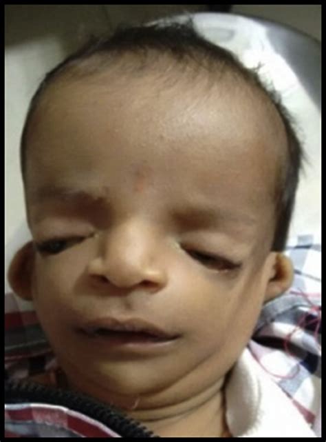 Facial Dysmorphism With Downslanting Palpebral Apertures Malar And Download Scientific