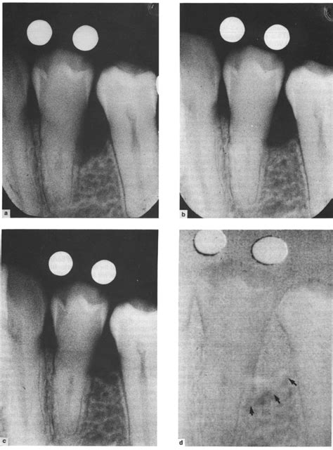 Serial Radiographs Showing Healing Of A Intrabony Defect Distal To The