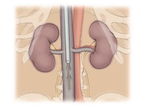 Ivc Filter Placement — The Interventional Initiative