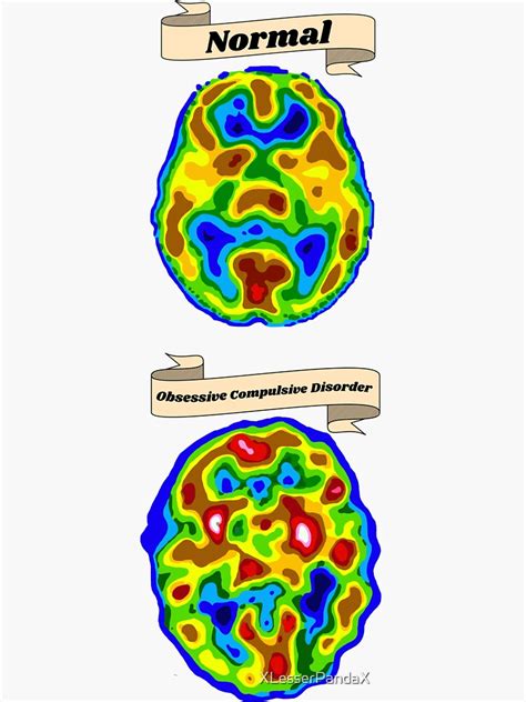 Copy Of Normal Vs Ocd Brain Scan Sticker For Sale By Xlesserpandax