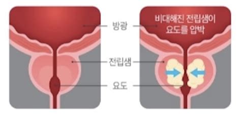 전립선비대증상 개선제 동국제약 카리토포텐 효능효과는 네이버 블로그