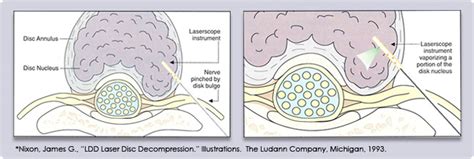 Northwest Brain And Spine Surgery Laser Discectomy