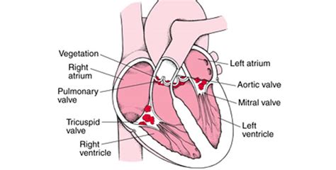 Infektivni Endokarditis Zdravlje