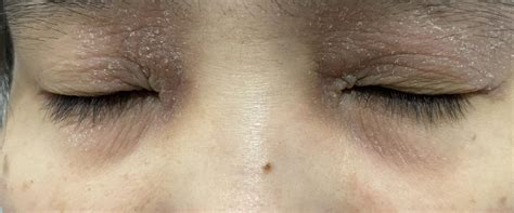 ภูมิแพ้จมูกลามขึ้นตา Allergic Rhinitis And Atopic Dermatitis Of Eyelids