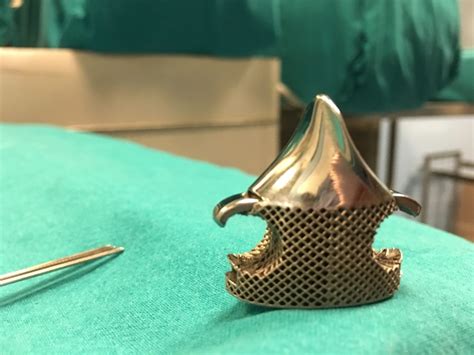 Metal Additive Manufacturing Speeds Innovation In Spinal Devices