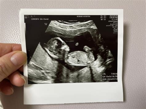 40대 시험관 임신 12주13주14주 증상 그리고 여전한 입덧 네이버 블로그