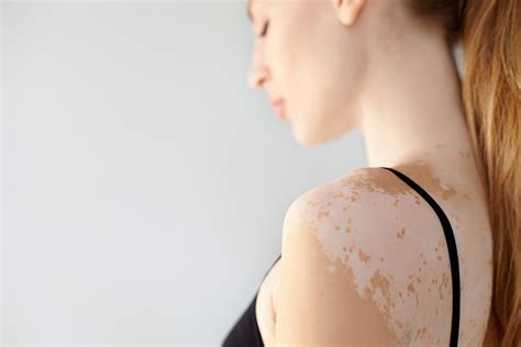 ¿qué Es El Vitíligo Skinexpert Sesderma