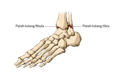 Patah Pergelangan Kaki Gejala Dan Mengobati Alodokter