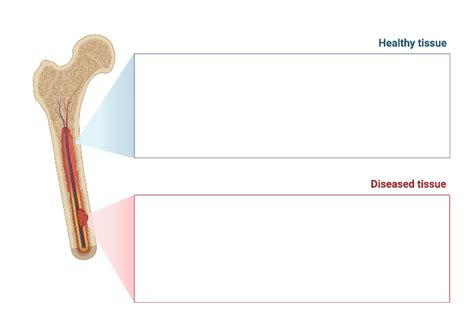 Healthy And Diseased Bone Marrow With Callout Layout 2 BioRender