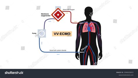 Venovenous Extracorporeal Membrane Oxygenation Vv Ecmo Stock Vector Royalty Free 2506325013