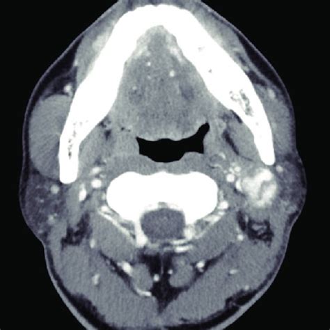 Patient Positioning For Left Robotic Partial Nephrectomy Download