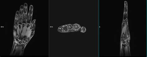Mri Thumb Mri Thumb Protocol And Planning
