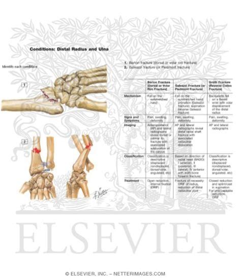 Learningradiology Galeazzi And Monteggia Fracture