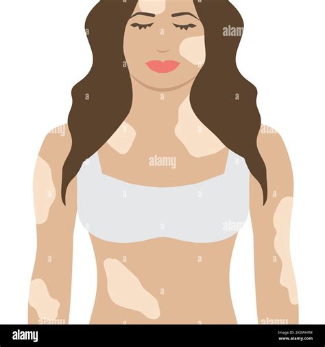 Woman With Vitiligo Isolated Illustration Stock Vector Image And Art Alamy