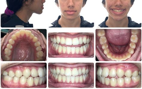 Elastics Marin Ortho Orthodontist Larkspur Bay Area