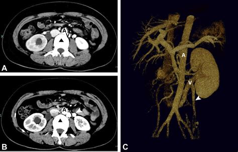 Congenital Renal Arteriovenous Malformation Semantic Scholar