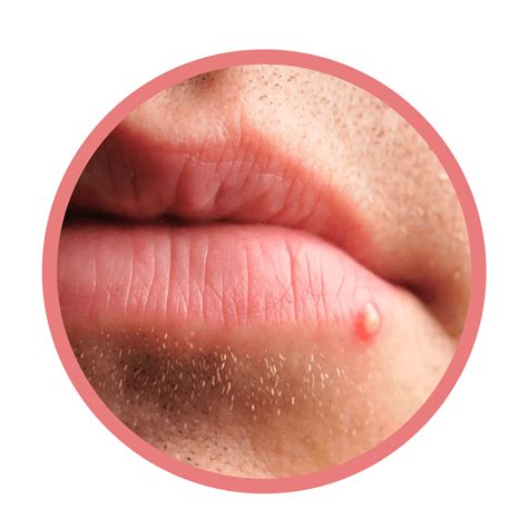 Bump On Upper Lip