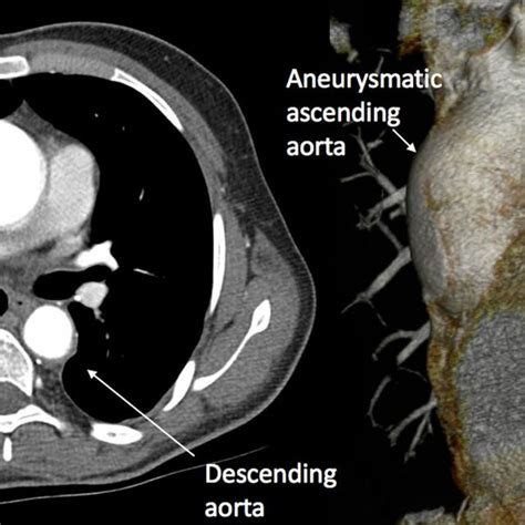 A Aneurysm Of The Ascending Aorta Is Observed On Preoperative Cta And Download Scientific
