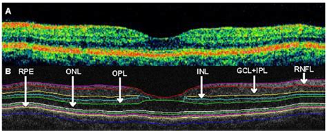 Macular Image Segmentation Using Octrima The Image Of A Healthy Macula