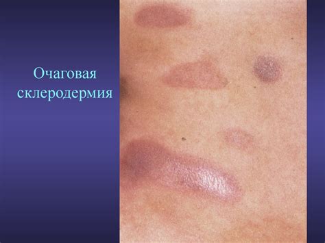 Системные заболевания кожи презентация онлайн