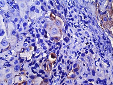 The Decreased Intensity Of Membranous Staining In Tumor Cells 1