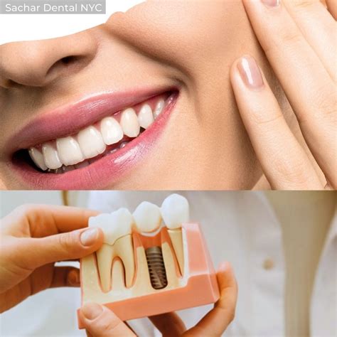 Enhance Your Smile Expert Dental Implants In Sachar Dental Nyc