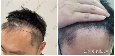 别让植发毁一生，能劝一个是一个！大麦、碧莲盛植发、公立三甲 哪家值得选？植发医生不会说哪些事情？过来人分享经验 知乎