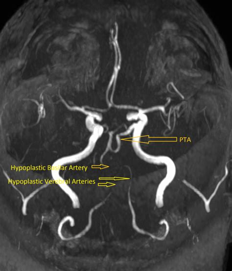 Persistent Primitive Trigeminal Artery Pacs